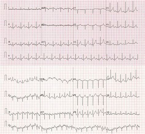 Focal Atrial Tachycardia During Central Gemcitabine Administration