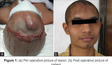 Figure 1 From Surgical Management Of Scalp Arterio Venous Malformation And Scalp Venous