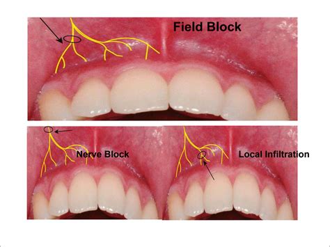 Solution 3 Techniques Of Maxillary Anesthesia Studypool