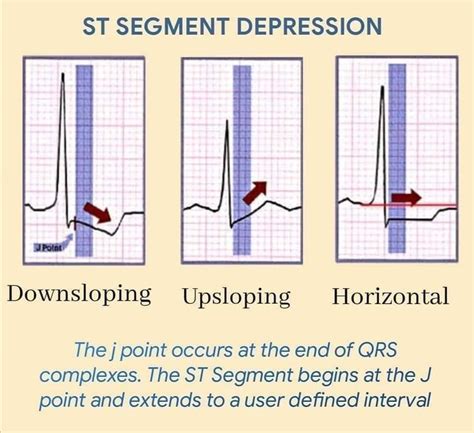 🔴 St Segment Depression 1 St Depression Can Be Either Upsloping