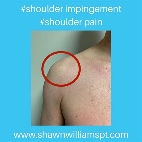 Shawn Williams Registered Physiotherapist Subacromial Impingement Or Shoulder Impingement