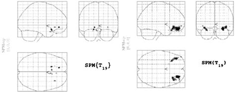 Global Brain Analysis For Interactions Between Feedback Conditions And