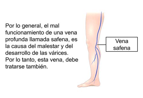 Várices Y Cirugía