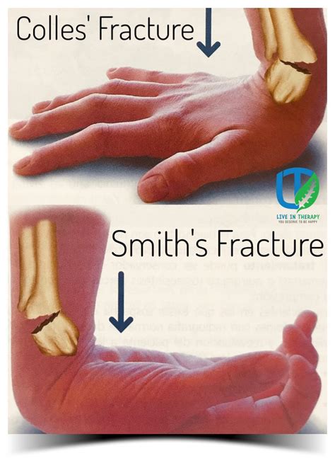 Colles And Smiths Fractures Causes And Treatments Nasir Khan Pt
