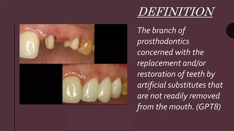 Parts Of Fixed Partial Denture Pptx