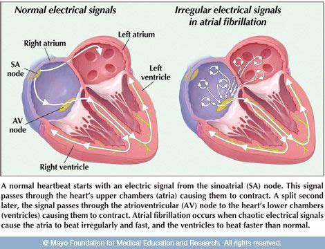 Pin On Atrial Fibrillation