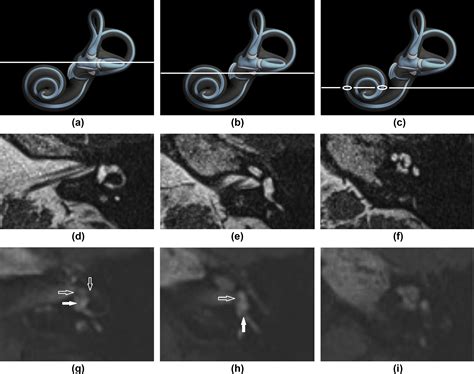 Endolymphatic Hydrops Magnetic Resonance Imaging In Ménières Disease