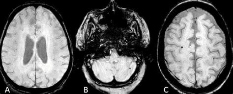 Microhemorrhages A Swi Images Show The Diffuse Pattern Of