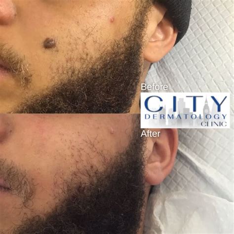 Shave Excision Mole Removal How It Works And What To Expect