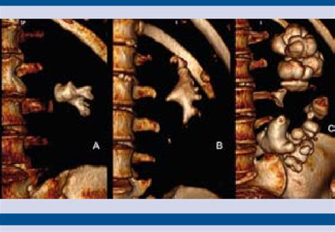 Clasificación Volumétrica De La Litiasis Coraliforme Según Descrita