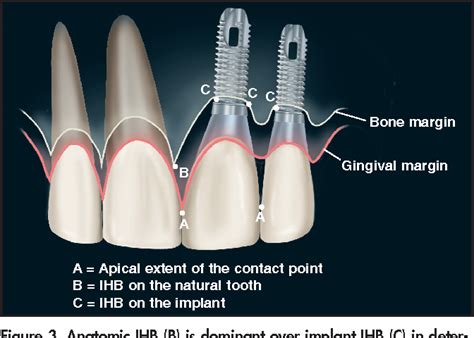 Pdf The Interproximal Height Of Bone A Guidepost To Predictable