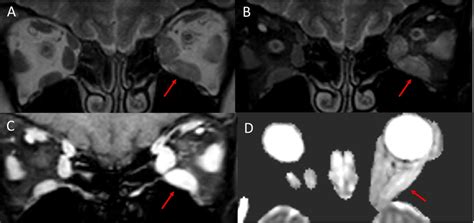 Ophthalmology Thyroid Mri