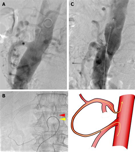 Angiogram Celiac Axis