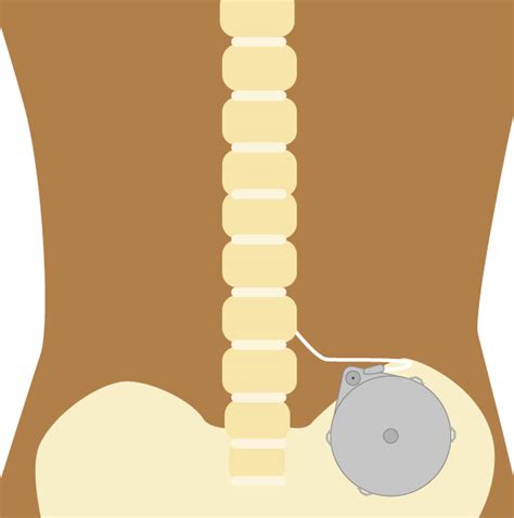 Intrathecal Pump A Tricumed Ip2000v Infusion Pump And Spinal Catneter