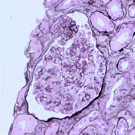 Glomerulosclerosis Histology