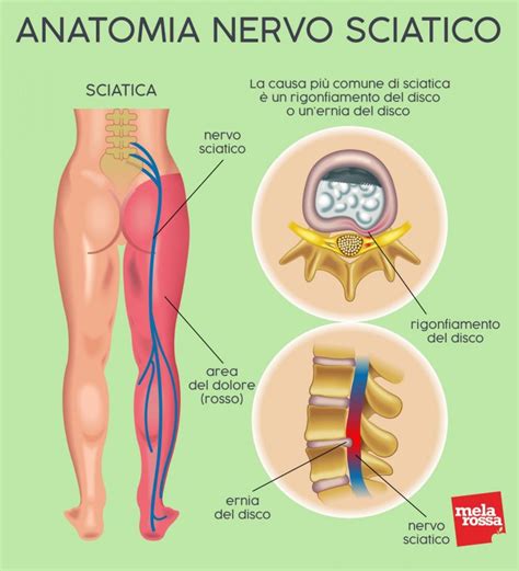 Nervo Sciatico Cosè Sintomi Prevenzione E Le Cure Quando Si Infiamma
