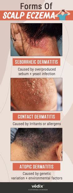 Seborrheic Dermatitis Remedies Tips