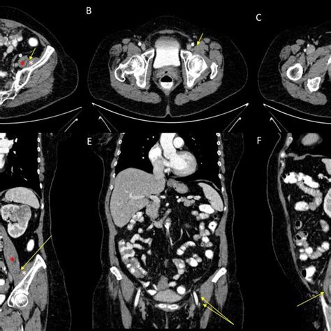 Anatomical Route Of The Femoral Nerve Femoral Nerve Yellow Arrow