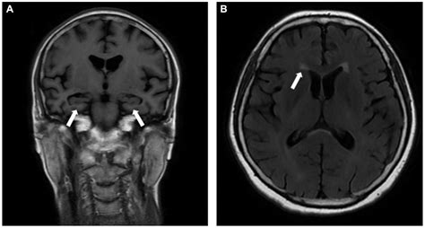 Frontiers Missense Mutation Of Angiotensin Converting Enzyme Gene In An Alzheimers Disease