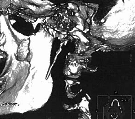 3d Reconstruction Of Ct Images Showing Elongation Of The Left Styloid Download Scientific