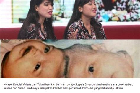 Kisah Inspiratif Yuliana Yuliani Si Kembar Siam