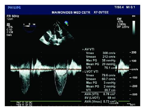 Tee Image Of The Deep Transgastric Long Axis Deep Tg Lax View Download Scientific Diagram