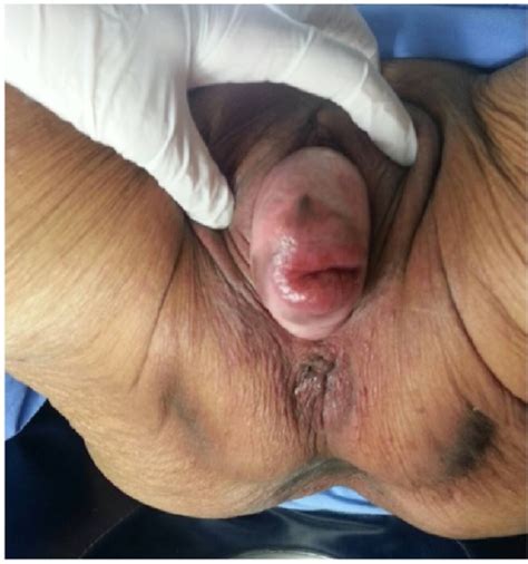 Pelvic Organ Prolapse Wikem