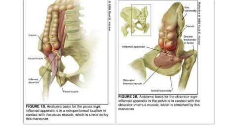 Psoas Sign And Obturator Sign