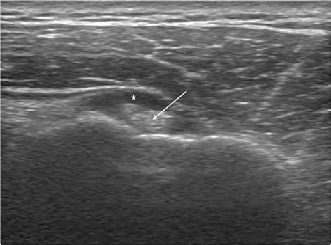 Sonographic Finding Of Long Head Of The Biceps Tendinitis The Arrow