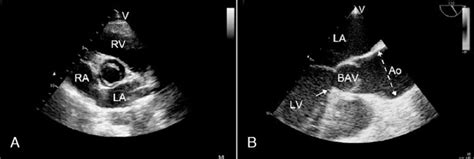 Aortic Valve Cusps Echo