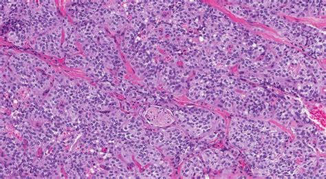 Solid Pseudopapillary Neoplasm Of The Pancreas Ottawa Atlas Of Pathology