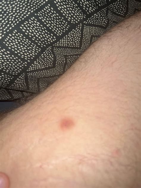 Post Scabies Syndromedisaese Rscabies