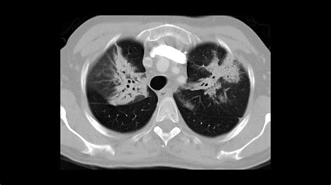 Bronchiolitis Obliterans