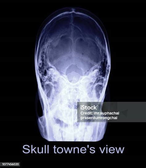 Imagen De Rayos X De La Vista De Towne De Cráneo Humano Foto De Stock Y