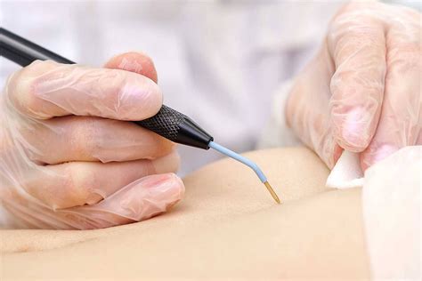 Cauterization Procedures Obstetrician And Gynecologist