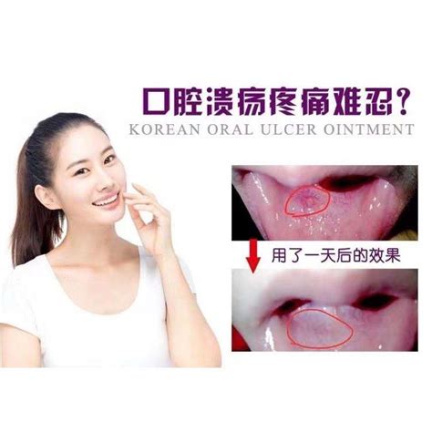 Gc Peridex Ointment For The Oral Cavity Disease 6g 韩国口腔溃疡膏6g