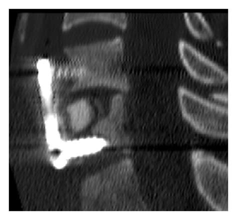 A B And C Postoperative Ct Scan Demonstrating A Good