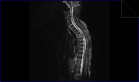 Metastatic Spinal Cord Compression Mri Radiology Article