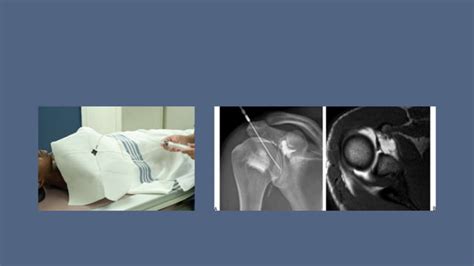 Radiographic Procedure Arthogrampptx