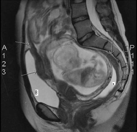 Magnetic Resonance Imaging Findings Of Diffuse Peritoneal Involvement