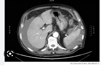 Hemoperitoneum Due To Trauma In The Superior Pancreatic Artery