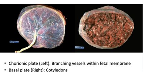 Placenta Pathology Repro E1 Update 2025 Dr Wang Flashcards Quizlet