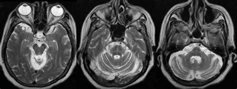 Neuroradiology Cases Multiple System Atrophy Mri