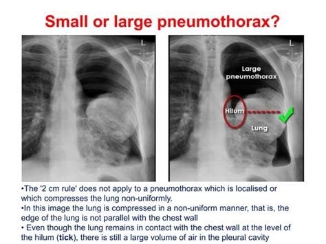 Pneumothorax In Chest Xray Interpretationpptx Pptx