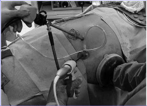 Right Hand Assisted Laparoscopic Radical Nephrectomy Using A Midline Download Scientific