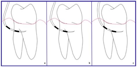 Furcation Involvement Classification A Comprehensive Review And A New