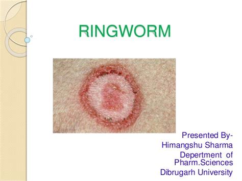 Ringworm