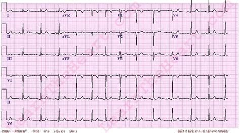 Sinus Arrhythmia