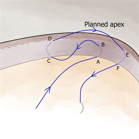 Modified Linear Closure With Standing Cone Management An Alternative