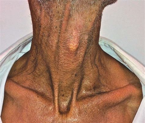 Клиничен случай лимфен възел на Вирхов